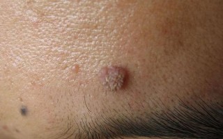 菜花状疣图片女性_早期症状有哪些