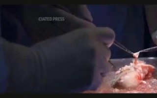 猪肾移植人体最新进展_猪肾移植人体能活多久