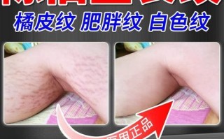 橘皮纹怎么消除_橘皮纹是什么原因