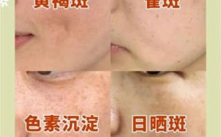 黄褐斑怎么淡化_黄褐斑图片怎么看