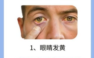 肝炎的症状有哪些_肝炎早期表现有哪些