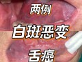 胃癌早期舌头图片_舌苔厚白是胃癌吗