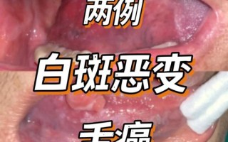 胃癌早期舌头图片_舌苔厚白是胃癌吗