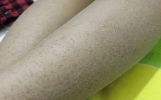 鱼鳞病会遗传吗_鱼鳞病怎么治最好