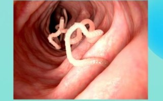 猪肉绦虫感染症状_潜伏期多久