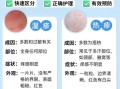 血热的症状有哪些_湿疹反复发作怎么办