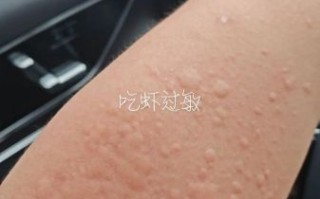 海鲜过敏症状怎么办_紧急处理步骤