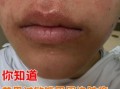 芒果过敏嘴唇长小颗粒怎么办_多久能好