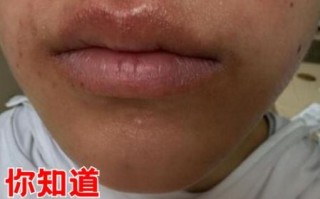 芒果过敏嘴唇长小颗粒怎么办_多久能好