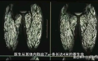 绦虫病症状_感染后多久出现