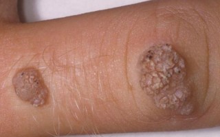 小菜花是什么病_小菜花初期症状图片