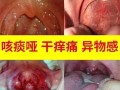 扁桃体发炎吃什么药_扁桃体肿大能自愈吗