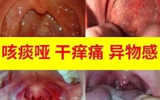 扁桃体发炎吃什么药_扁桃体肿大能自愈吗