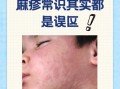 荨麻疹是因为太脏吗_荨麻疹和卫生差有关吗
