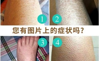 鱼鳞病图片_鱼鳞病初期症状图片