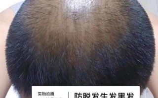 飞机打多了会脱发吗_多久能恢复