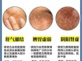 黄褐斑能自己消退吗_黄褐斑多久能淡化