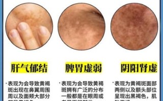 黄褐斑能自己消退吗_黄褐斑多久能淡化