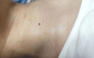 9度米醋治疣步骤_9度米醋去疣多久见效