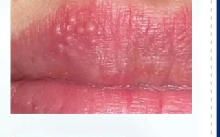 嘴唇起泡是癌的预兆_嘴唇起泡多久不愈合要警惕