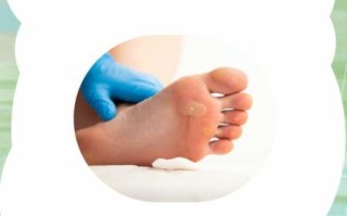 鸡眼怎么治_鸡眼贴多久能好