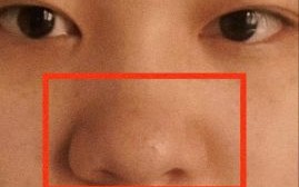 大蒜鼻整容效果图_真实案例