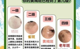 什么东西可以祛斑最快_祛斑效果最好的方法是什么