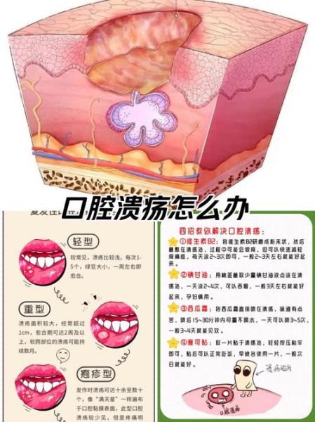 口腔溃疡怎么快速好_治口腔溃疡六个小偏方-第3张图片-山城妙识