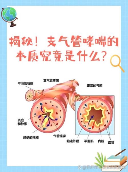 过敏性支气管哮喘的最佳治疗方法_如何根治不复发-第3张图片-山城妙识