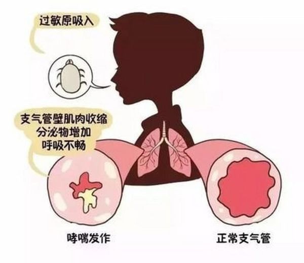 过敏性支气管哮喘的最佳治疗方法_如何根治不复发-第2张图片-山城妙识