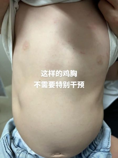 鸡胸轻度到重度图片_鸡胸怎么判断严重程度-第1张图片-山城妙识