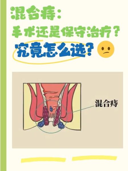 痔疮为什么不建议手术_痔疮保守治疗多久见效-第3张图片-山城妙识