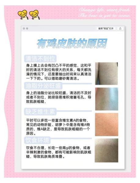 鸡皮肤怎么消除最有效_鸡皮肤用什么药膏最好-第3张图片-山城妙识 鸡皮肤怎么消除最有效_鸡皮肤用什么药膏最好-第3张图片-山城妙识