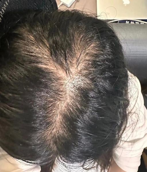 脂溢性脱发能自愈吗_脂溢性脱发好了还会复发吗-第1张图片-山城妙识 脂溢性脱发能自愈吗_脂溢性脱发好了还会复发吗-第1张图片-山城妙识