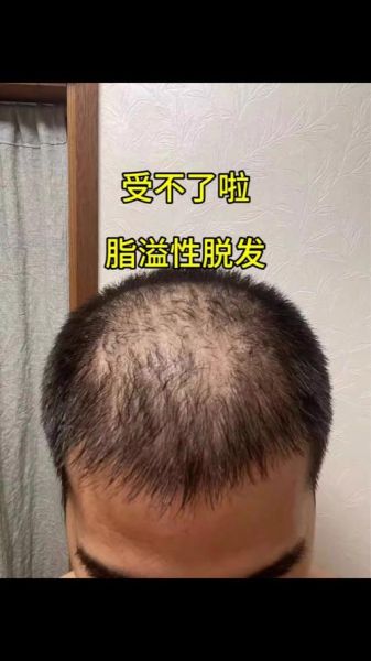 脂溢性脱发能自愈吗_脂溢性脱发好了还会复发吗-第2张图片-山城妙识 脂溢性脱发能自愈吗_脂溢性脱发好了还会复发吗-第2张图片-山城妙识