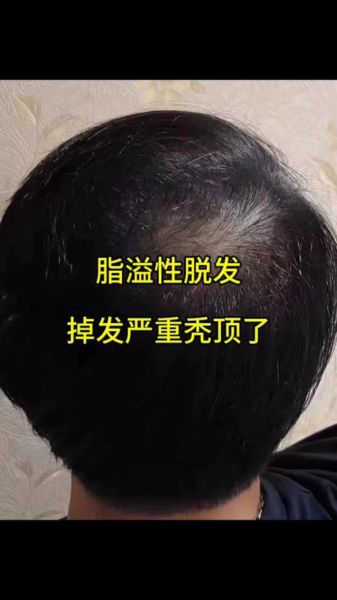 脂溢性脱发能自愈吗_脂溢性脱发好了还会复发吗-第3张图片-山城妙识 脂溢性脱发能自愈吗_脂溢性脱发好了还会复发吗-第3张图片-山城妙识