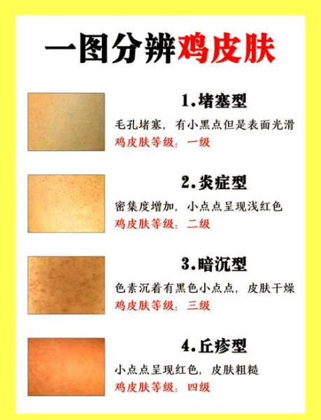 鸡皮肤怎么快速消除_鸡皮肤用什么药膏最有效-第2张图片-山城妙识 鸡皮肤怎么快速消除_鸡皮肤用什么药膏最有效-第2张图片-山城妙识
