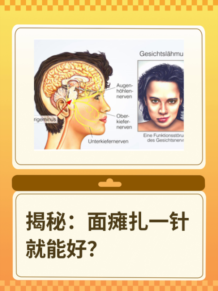 面瘫的自我治疗方法_面瘫多久能好-第3张图片-山城妙识