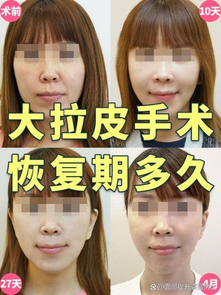 面部拉皮手术怎么做_面部拉皮能维持多久-第2张图片-山城妙识