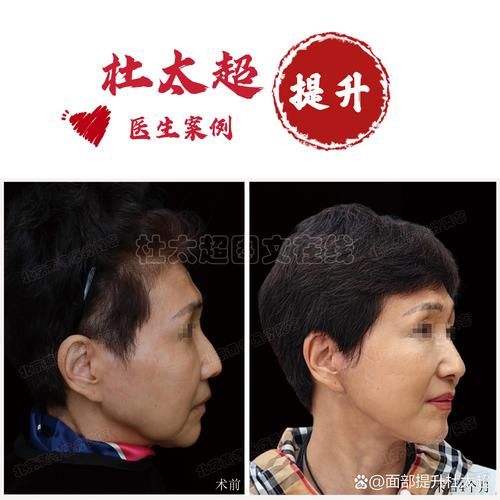 面部拉皮手术怎么做_面部拉皮能维持多久-第3张图片-山城妙识