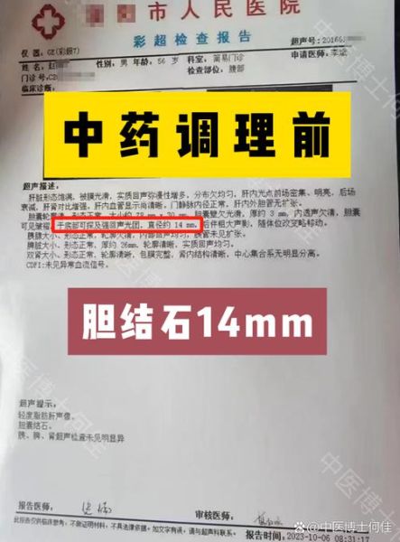 胆结石最佳治疗方法_胆结石偏方真的有效吗-第3张图片-山城妙识