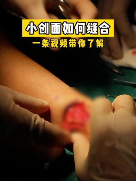 清创手术怎么做_清创缝合术后注意事项-第2张图片-山城妙识
