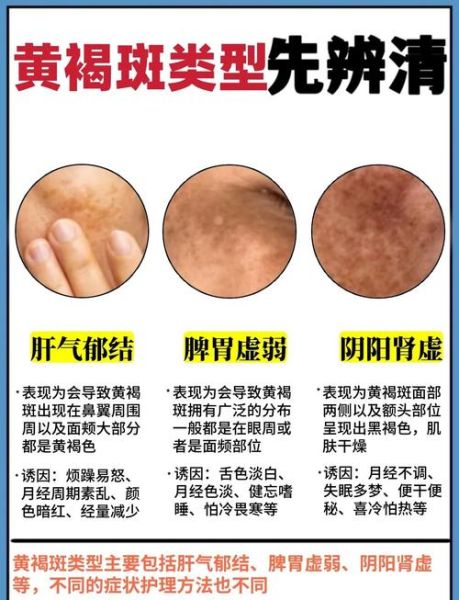 黄褐斑能自己消退吗_黄褐斑多久能淡化-第1张图片-山城妙识
