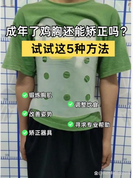 轻度小孩鸡胸图片_如何矫正-第1张图片-山城妙识