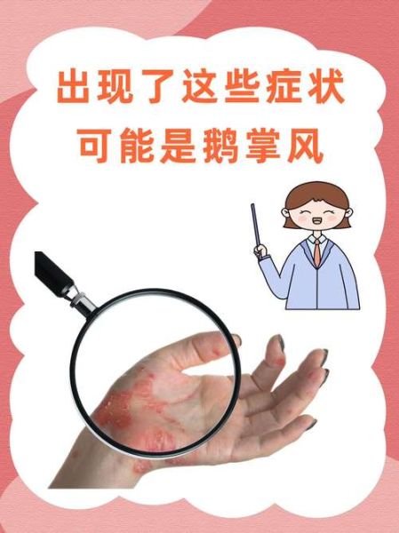 鹅掌风是怎么回事_鹅掌风是怎么引起的-第3张图片-山城妙识