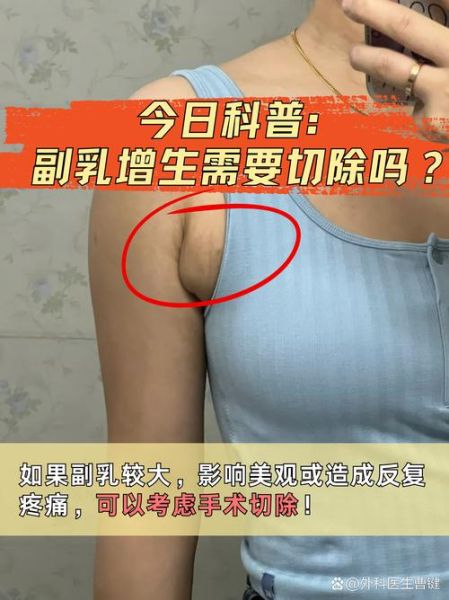 副乳切除手术大概需要多少钱_副乳手术价格影响因素-第3张图片-山城妙识