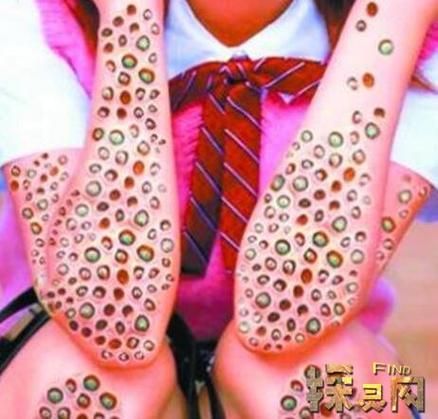 蓬蓬乳是什么_蓬蓬乳怎么治疗-第1张图片-山城妙识