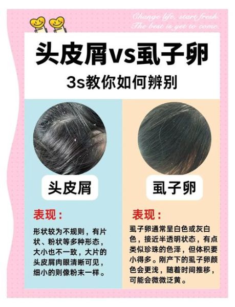 虱子卵长什么样_如何彻底清除虱子卵-第2张图片-山城妙识 虱子卵长什么样_如何彻底清除虱子卵-第2张图片-山城妙识