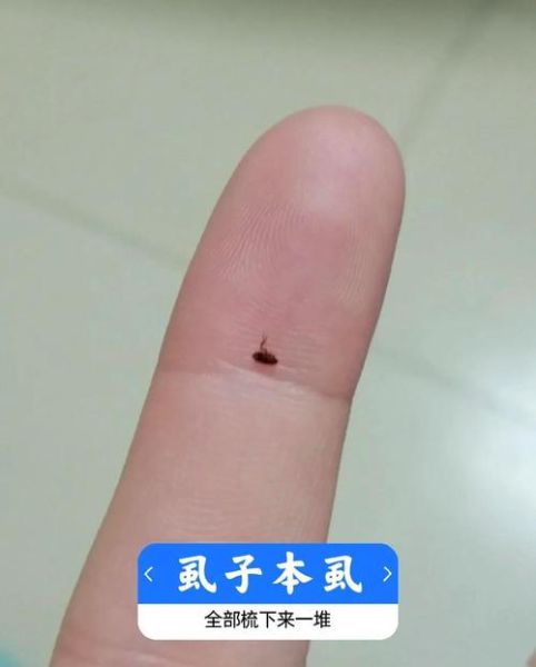 虱子卵长什么样_如何彻底清除虱子卵-第3张图片-山城妙识 虱子卵长什么样_如何彻底清除虱子卵-第3张图片-山城妙识