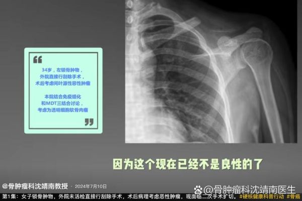 骨肉瘤恶性能活多久_晚期还能治好吗-第2张图片-山城妙识
